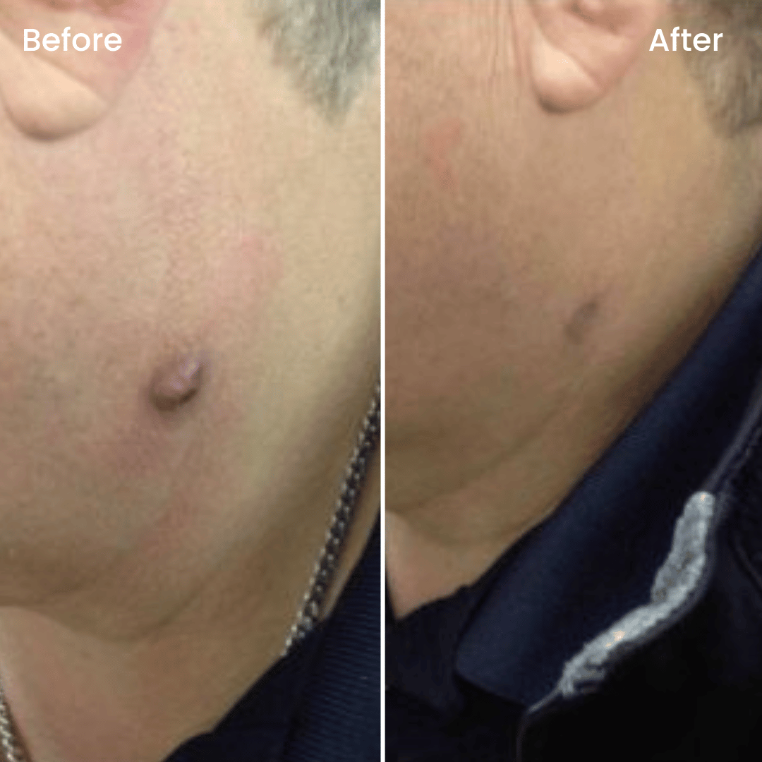 ICLS Cyst Removal Treatment